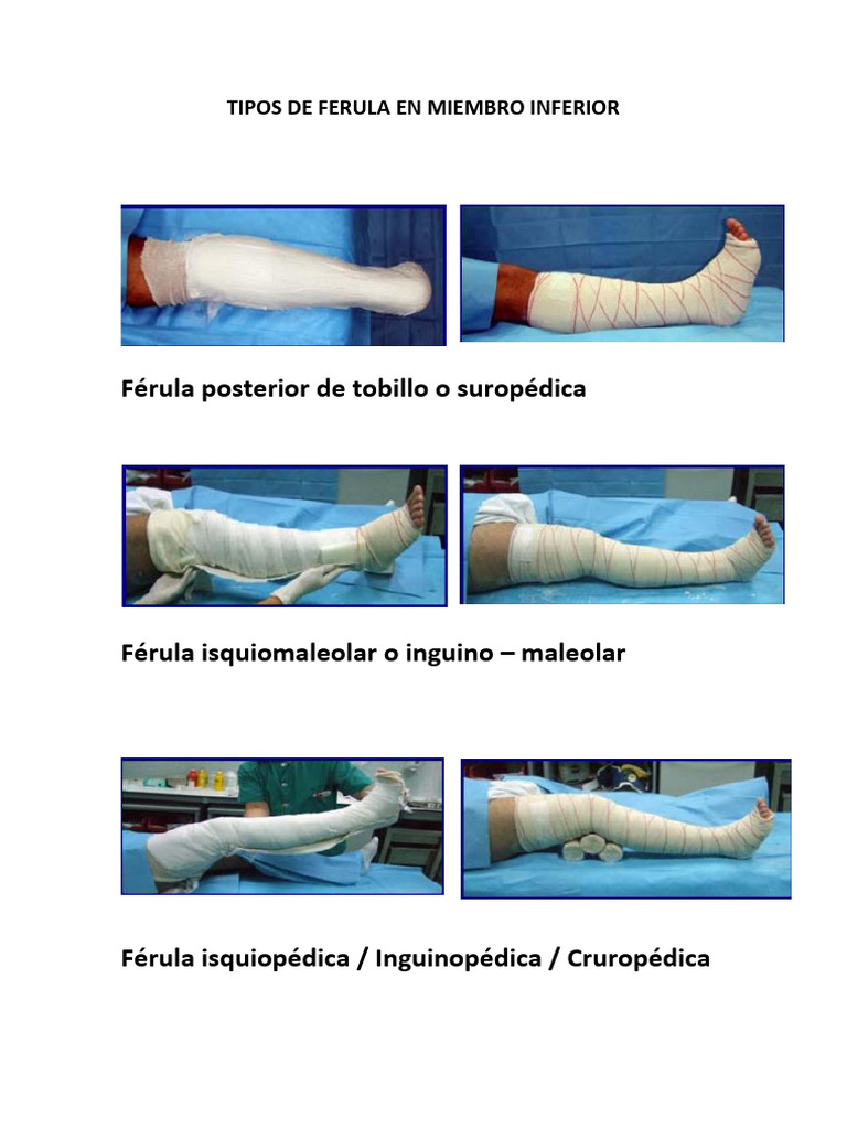 Tipos de Ferula en Miembro Inferior | PDF