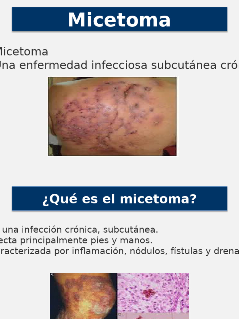 Copia de Presentación - Micetoma - Plantilla - Moderna | PDF