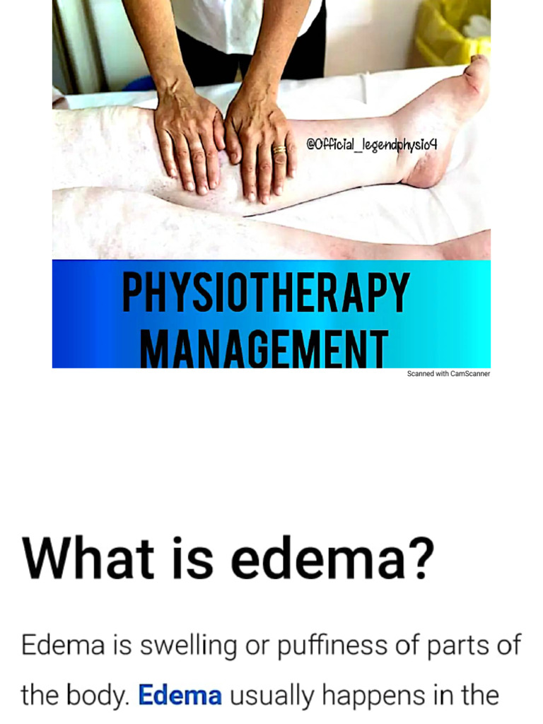 Edema With Physiotherapy Management | PDF