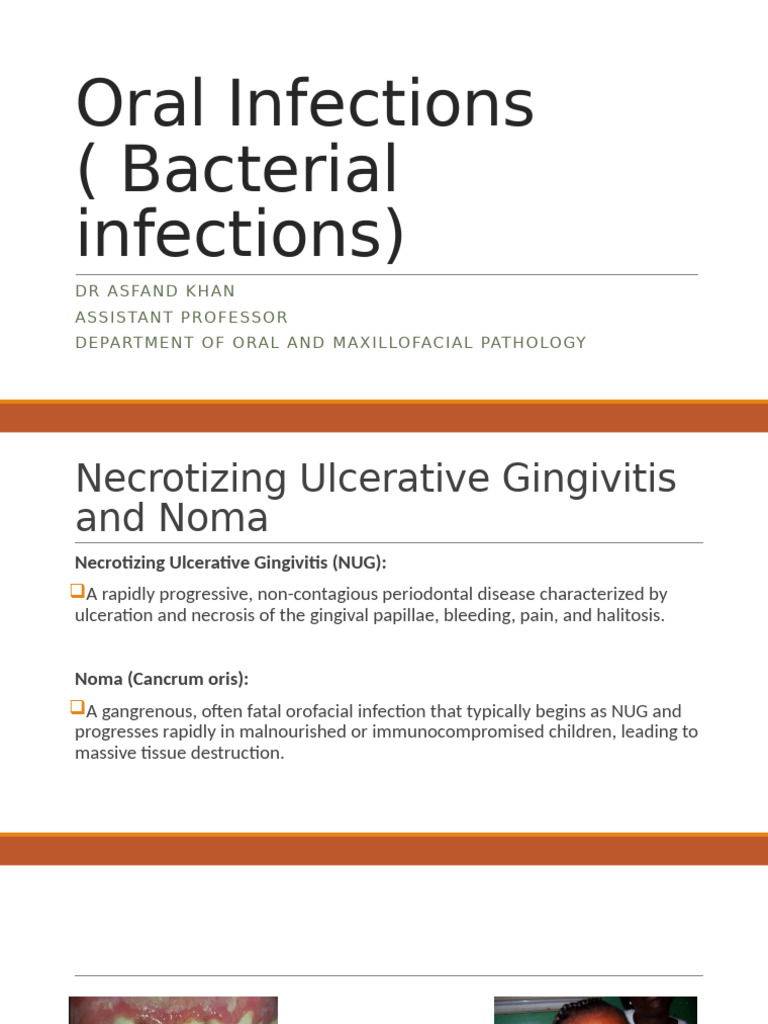 Bacterial Infection 2nd Year Bds | PDF | Tuberculosis | Medical Specialties