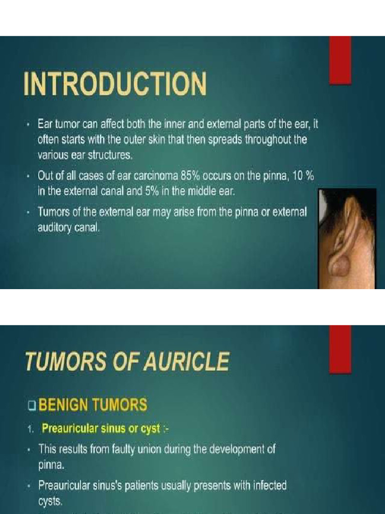 Ear Tumors | PDF