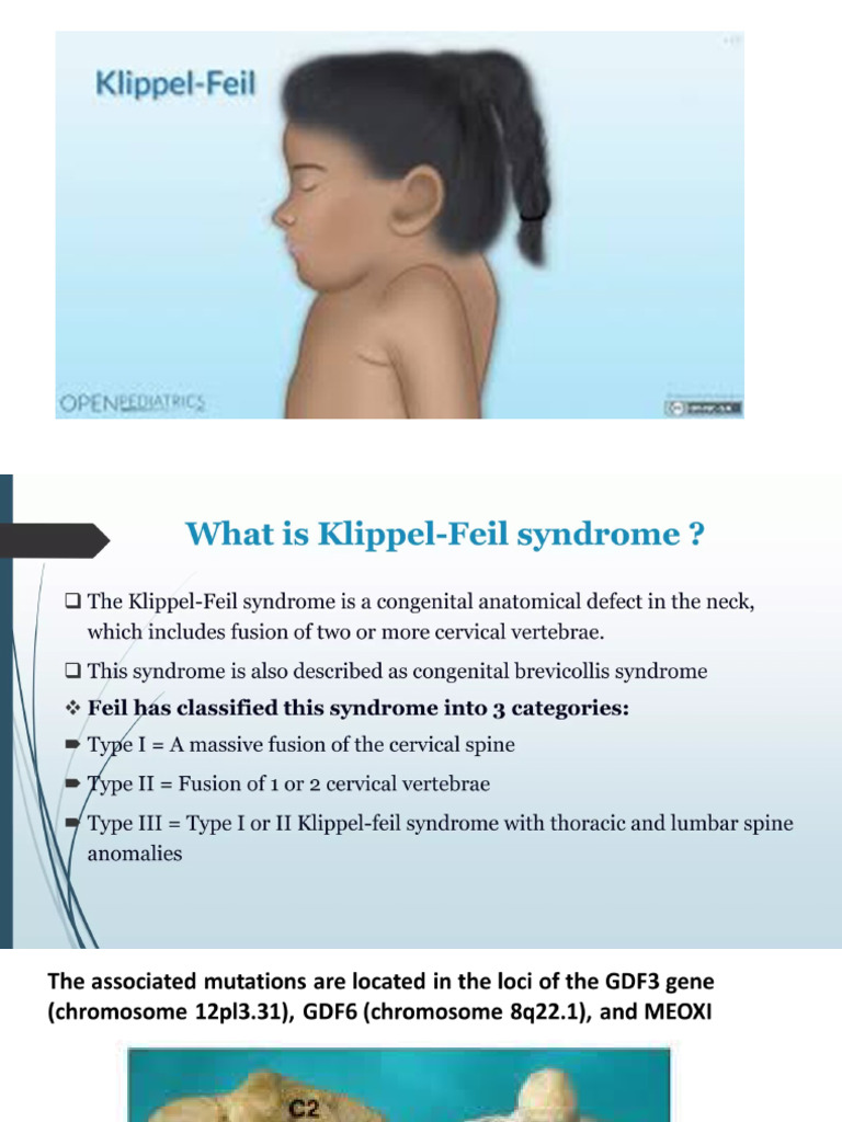 Autism and Klipel Fliel Syndrome | PDF | Autism | Behavioural Sciences