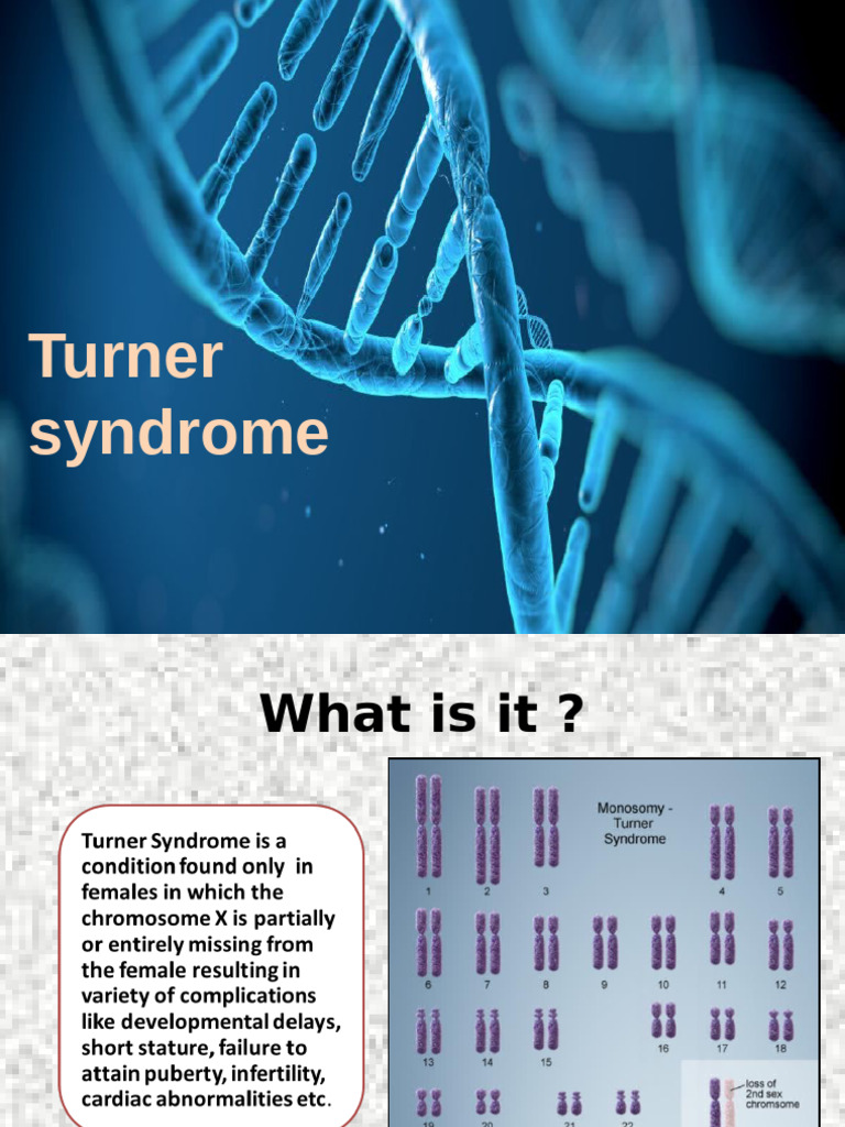2.2. Turner Syndrome | PDF