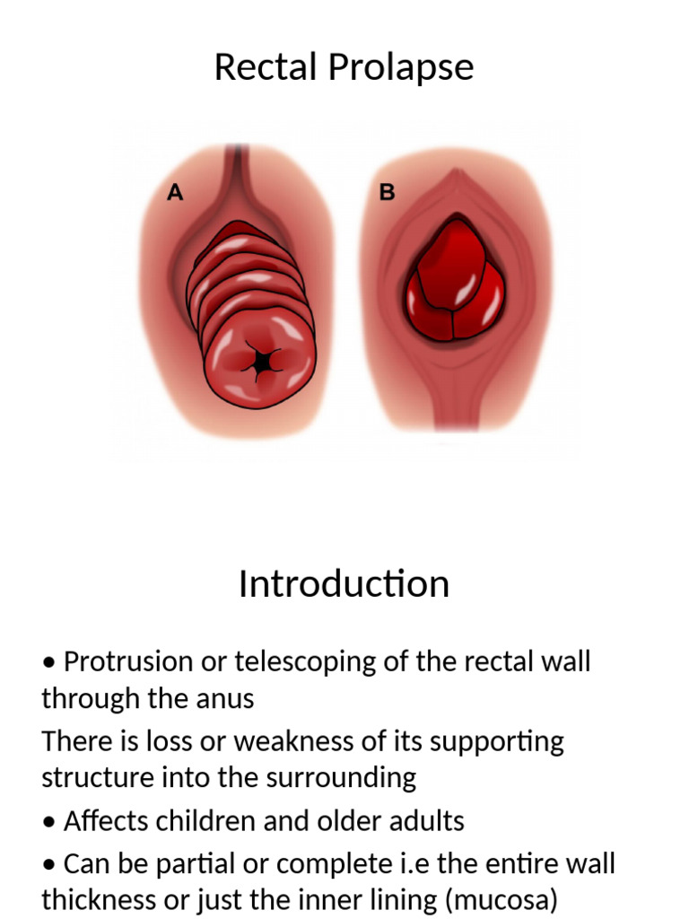 Rectal Prolapse Presentation | PDF