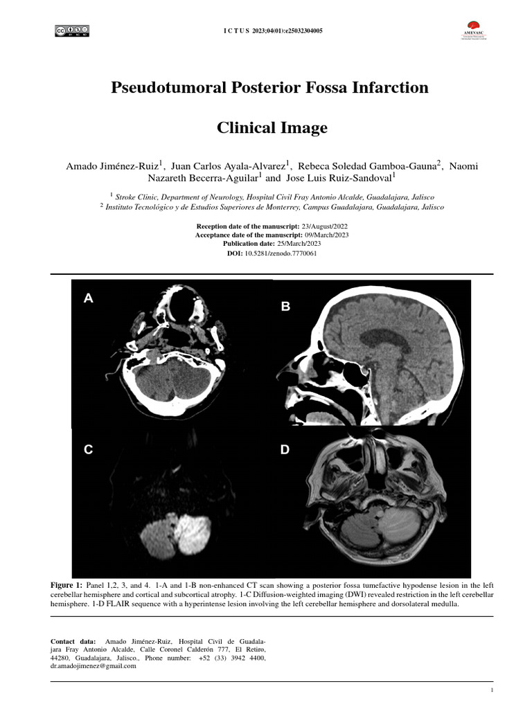 Imagen Infarto Pseudotumoral 2023 | PDF | Stroke | Cerebellum