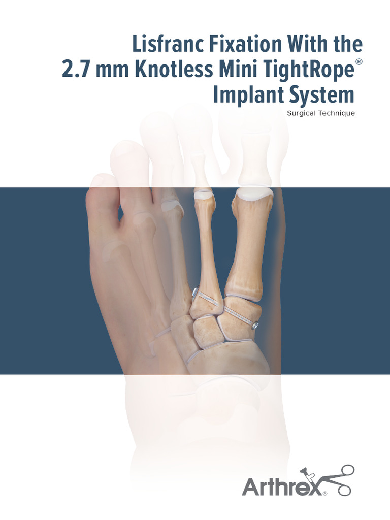 Lisfranc Fixation with Mini TightRope | PDF | Musculoskeletal System