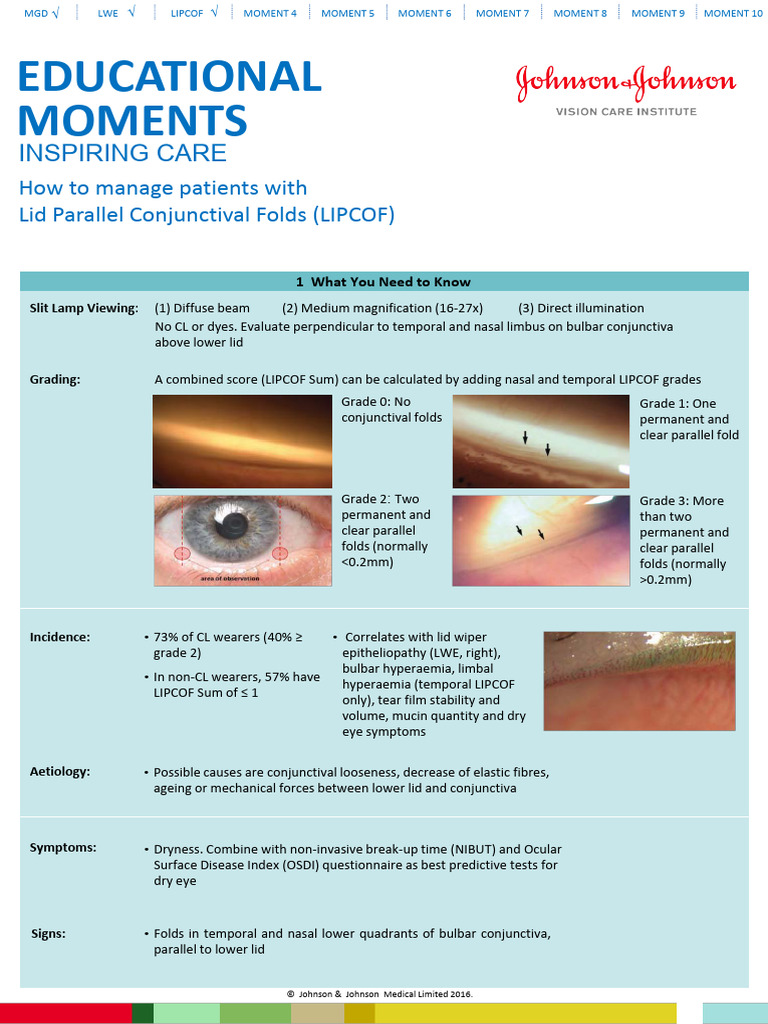 Lid Parallel Conjunctival Folds (LIPCOF) | PDF | Optics | Ophthalmology