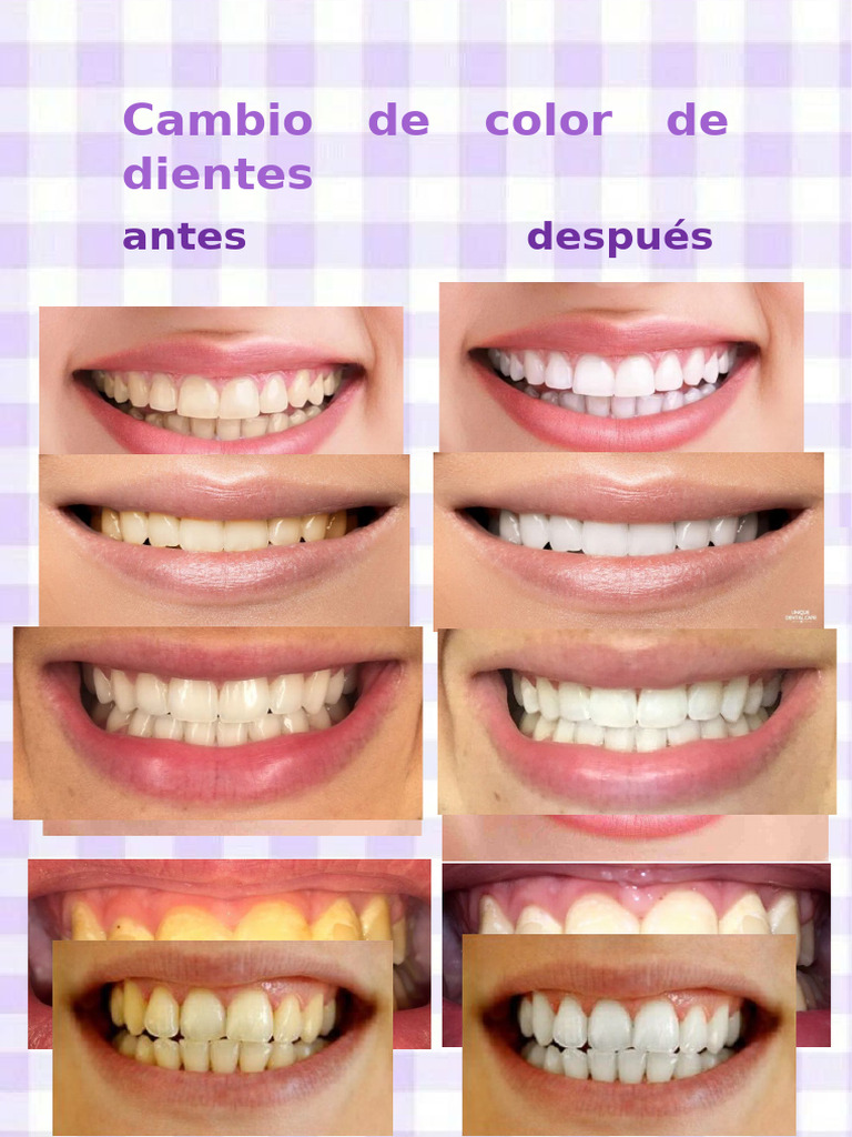 Cambio de Color de Dientes | PDF