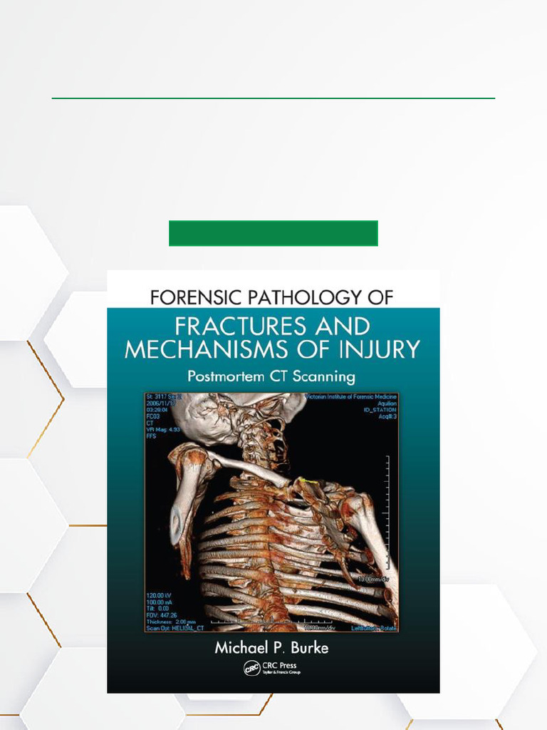 Forensic Pathology of Fractures and Mechanisms of Injury Postmortem CT ...