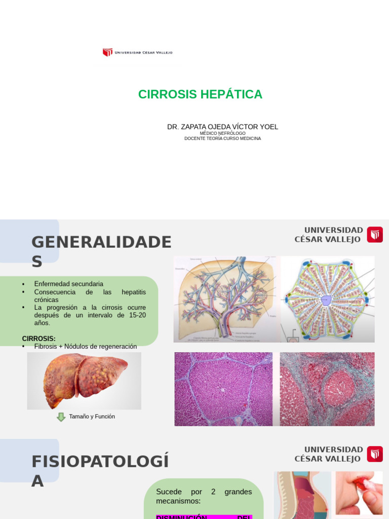 Cirrosis Hepática | PDF | Cirrosis | Especialidades Medicas