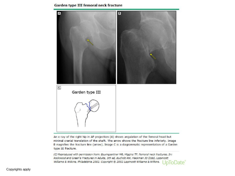 Garden Type III Hip Fracture | PDF