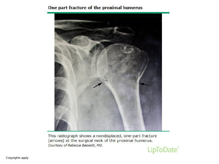 Humeral Fracture Proximal One Part | PDF
