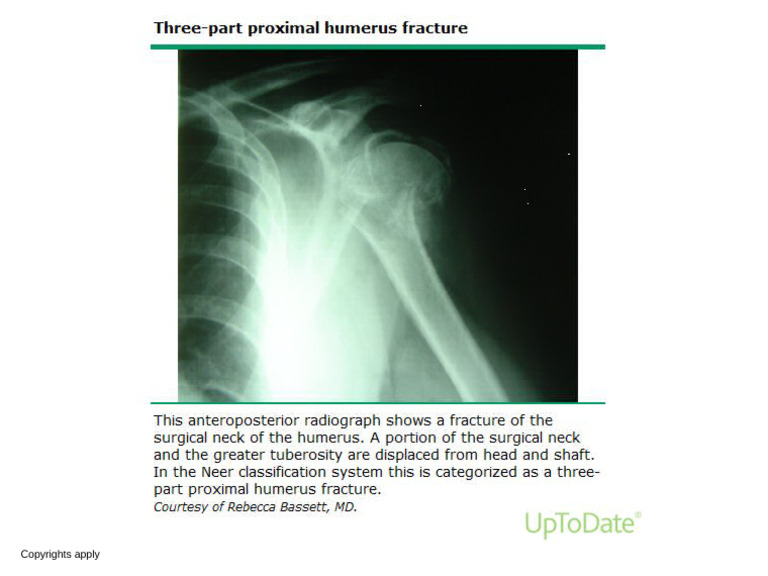 Adult Three Part Humerus Fracture | PDF