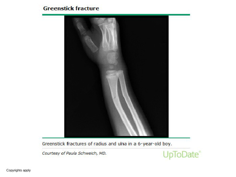 Greenstick_fracture | PDF