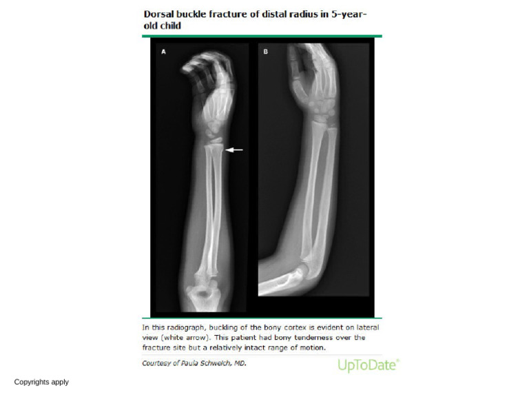Buckle Fracture Radius | PDF