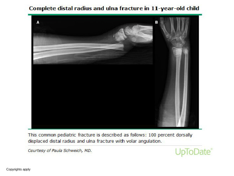 Complete Distal Radius and Ulna Fracture Child | PDF