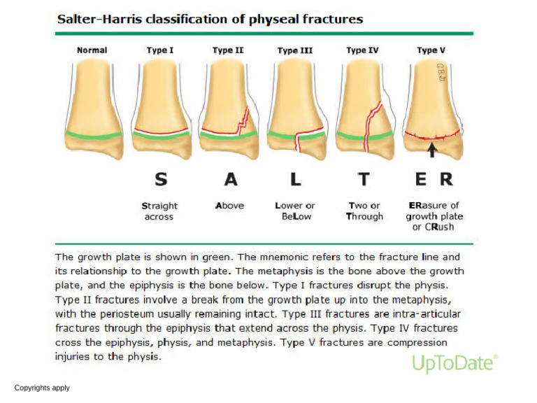 Salter Harris Classification of Physeal Fractures | PDF