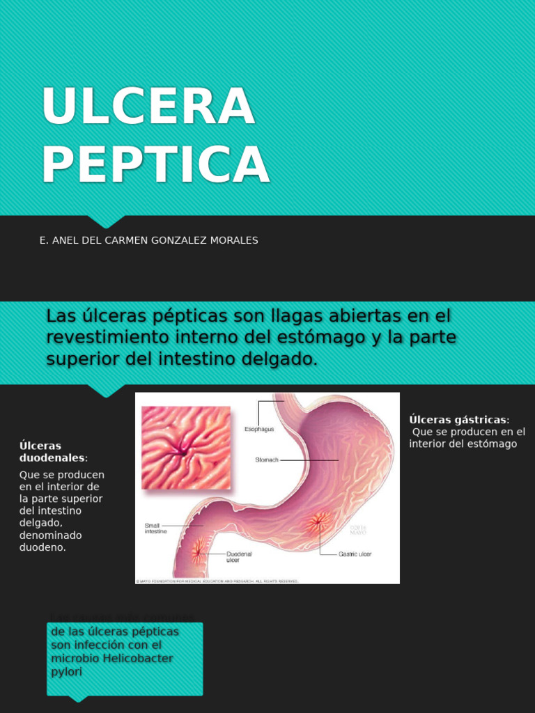Ulcera Peptica | PDF
