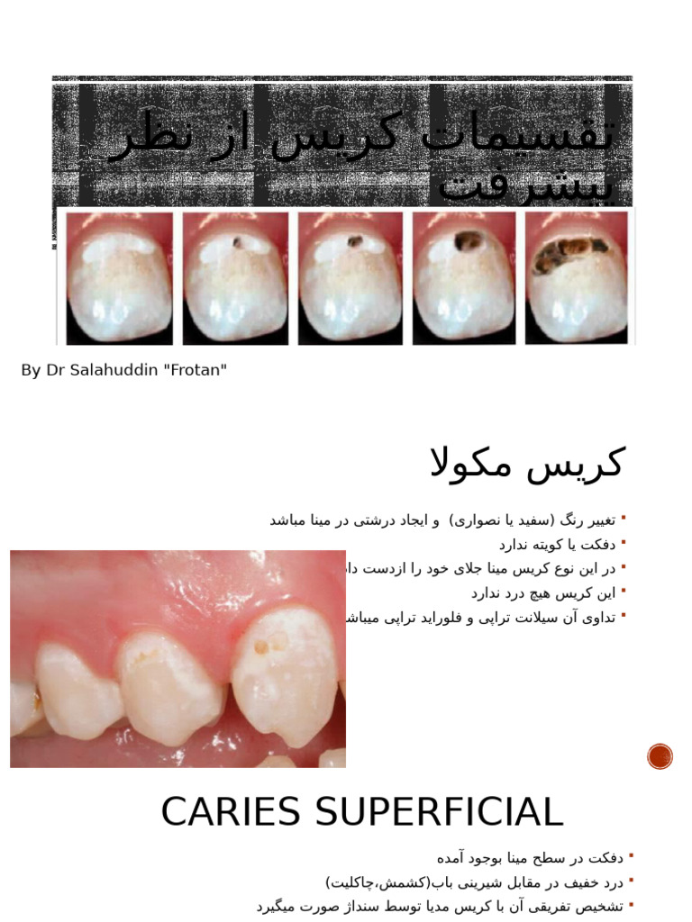 Classification of Tooth Decay According To Progression | PDF