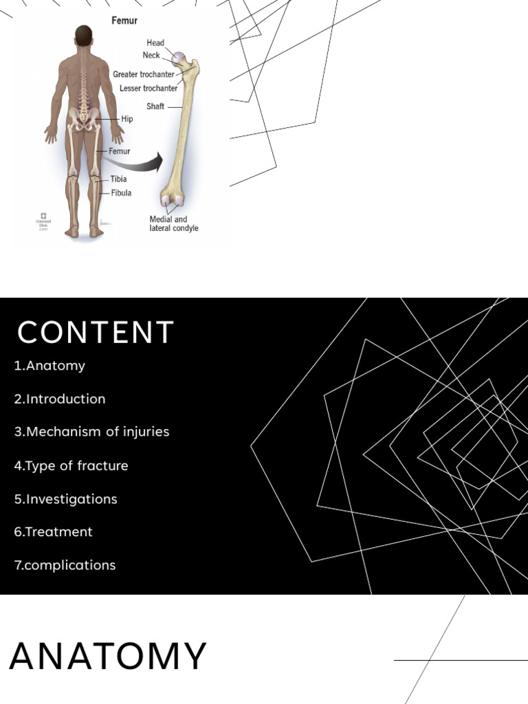 Condylar Fracture of Femur | PDF | Knee | Skeletal System