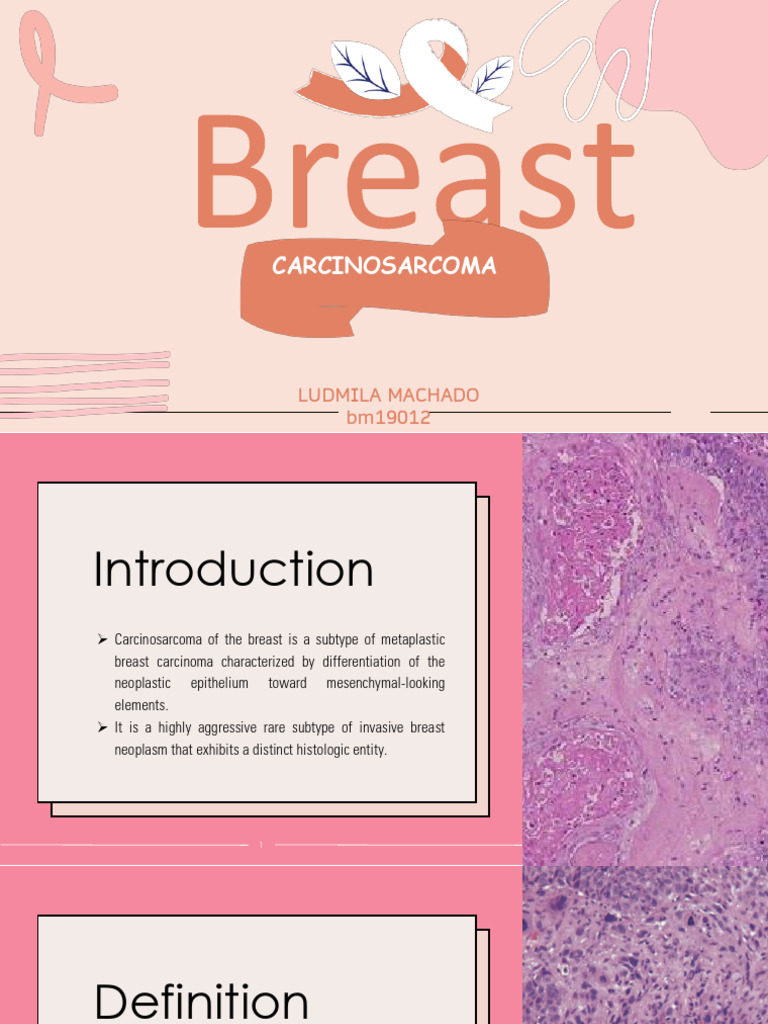 PRESENTATION Breast Carcinosarcoma | PDF | Breast Cancer | Carcinoma