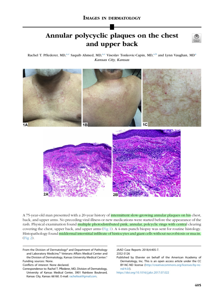 Annular Polycyclic Plaques On The Chest and Upper Back | PDF | Medical ...