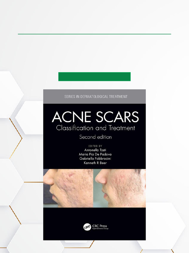 Acne Scars Classification and Treatment, Second Edition, 2nd Edition ...