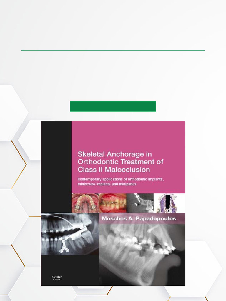 Skeletal Anchorage in Orthodontic Treatment of Class II Malocclusion ...