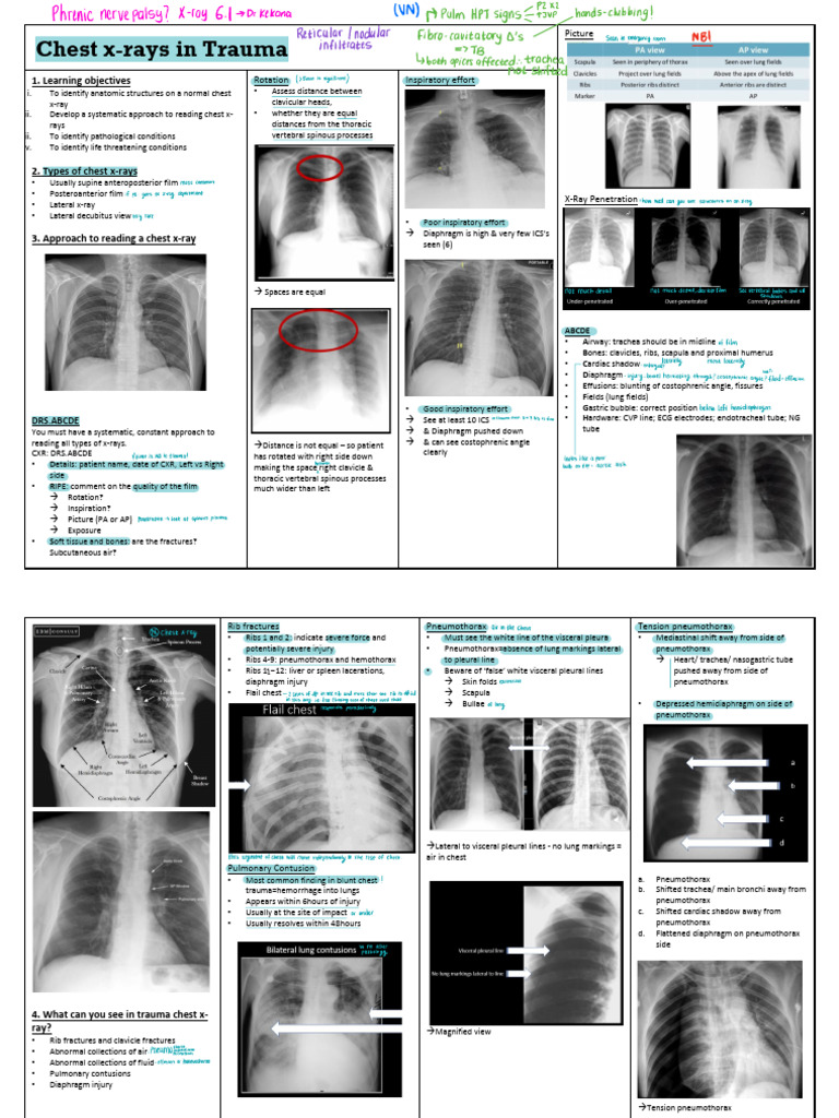 Chest X-Rays in Trauma | PDF | Thorax | Lung