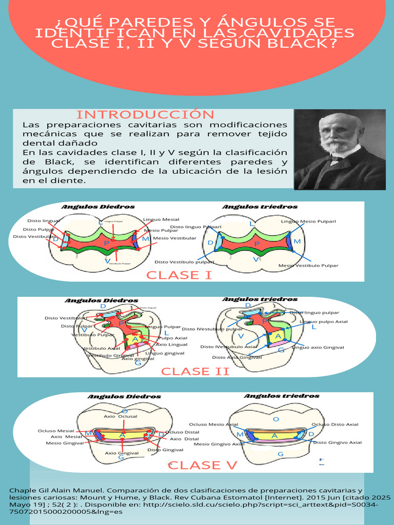 ¿Qué Paredes y Ángulos Se Identifican en Las Cavidades Clase I, II y V ...