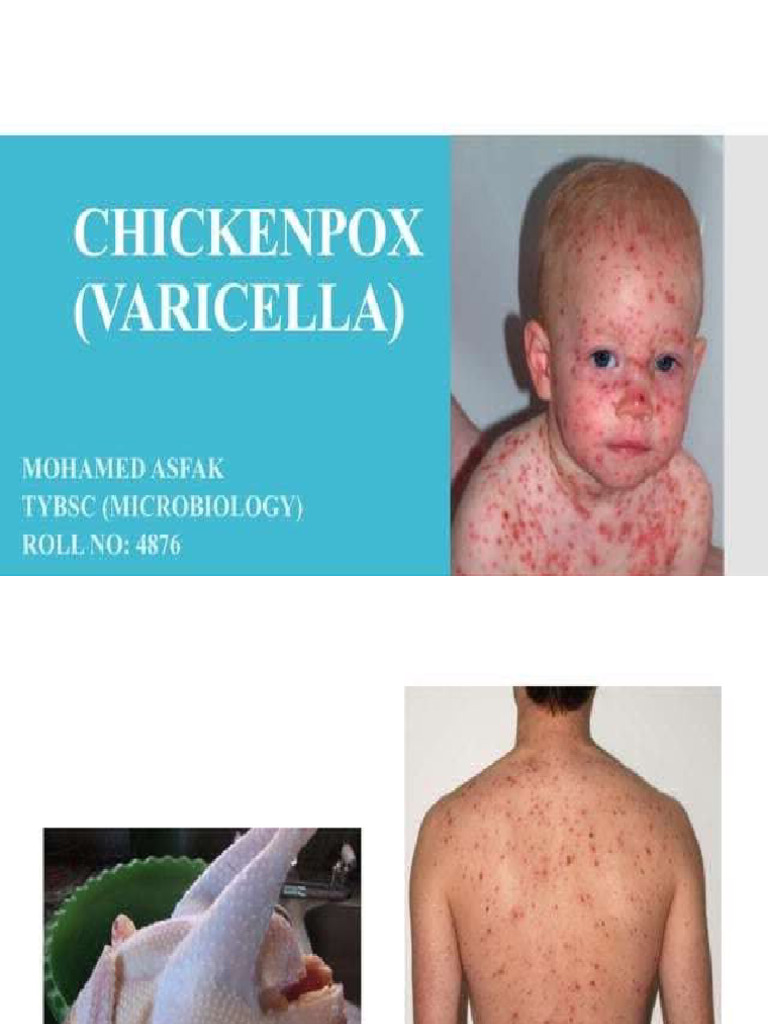 Varicella | PDF