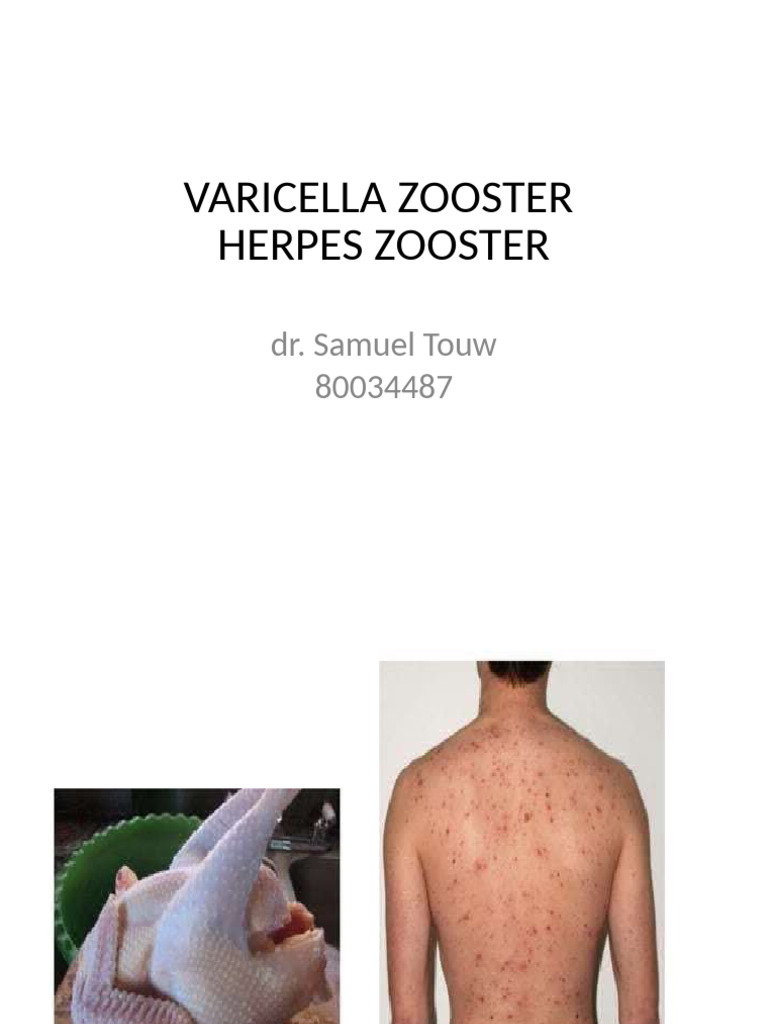 Varicella Zoster Treatment Guidelines | PDF