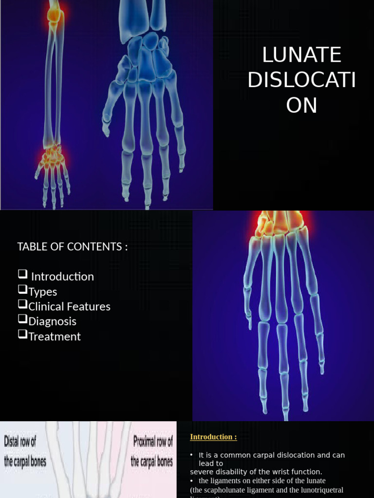 LUNATE Dislocation | PDF