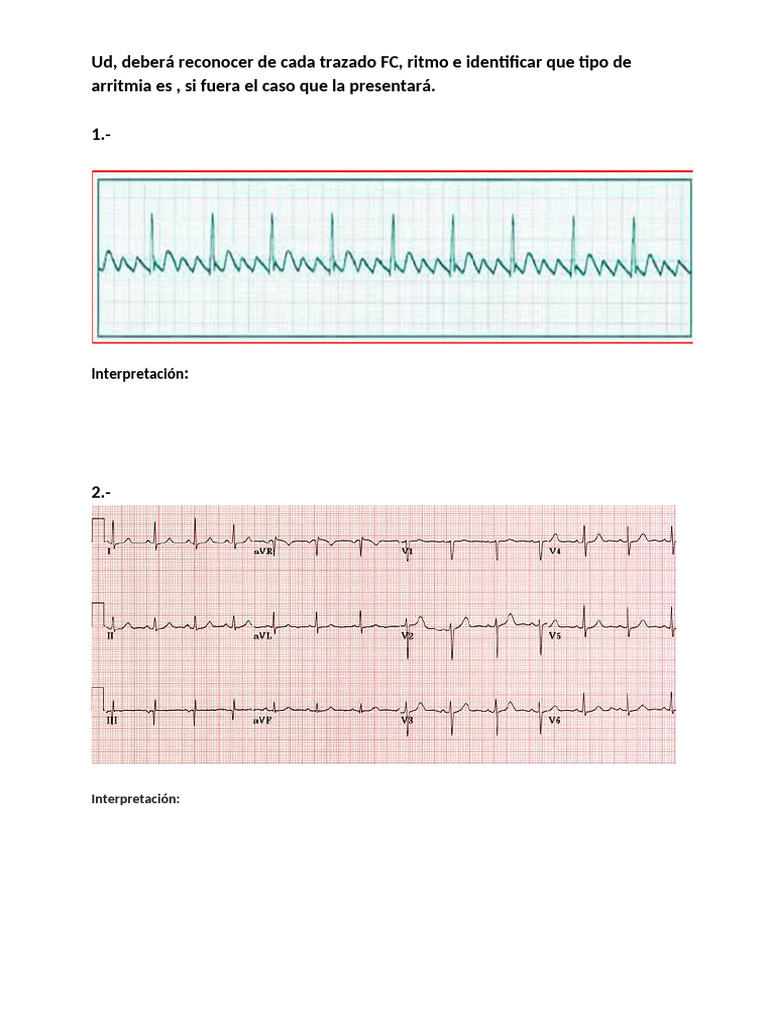 Trazos de Ecg | PDF