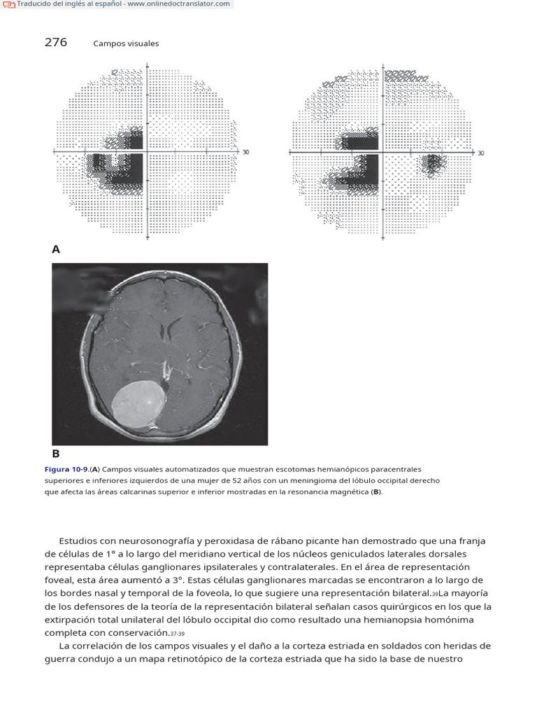 Thomas Walsh Visual Fields Ophth-6.en.es | PDF | Lóbulo occipital ...