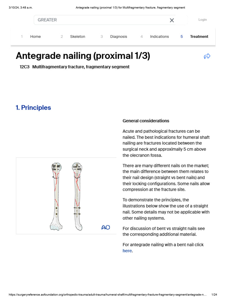 Antegrade Nailing (Proximal 1 - 3) For Multifragmentary Fracture ...