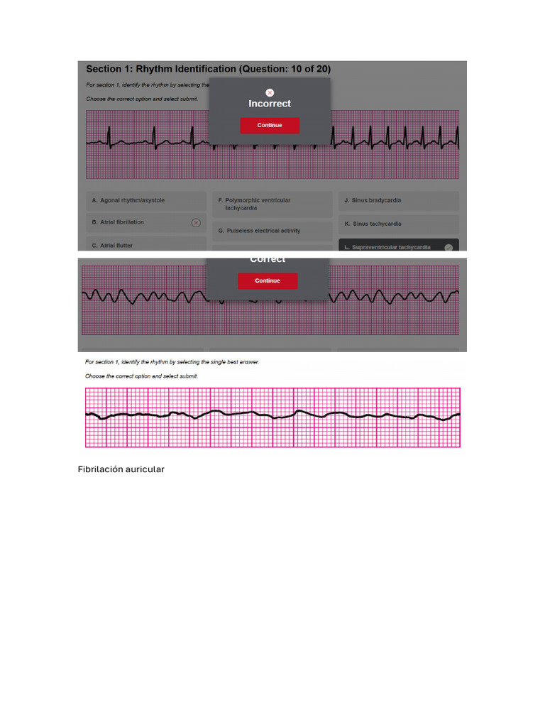 ACLS pre test | PDF