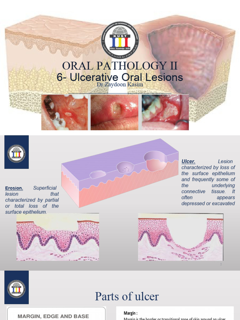 6 - Ulcerative Oral Lesions | PDF | Medical Specialties | Diseases And ...