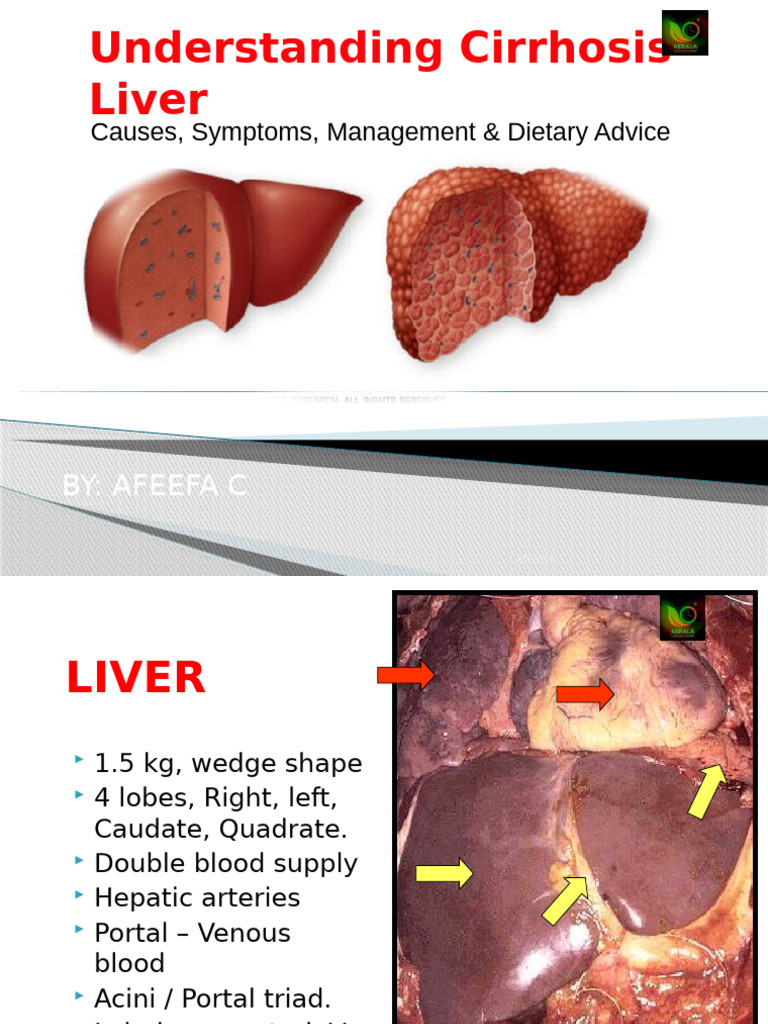 Livercirrhosis-By Afeefa C - T | PDF | Cirrhosis | Liver