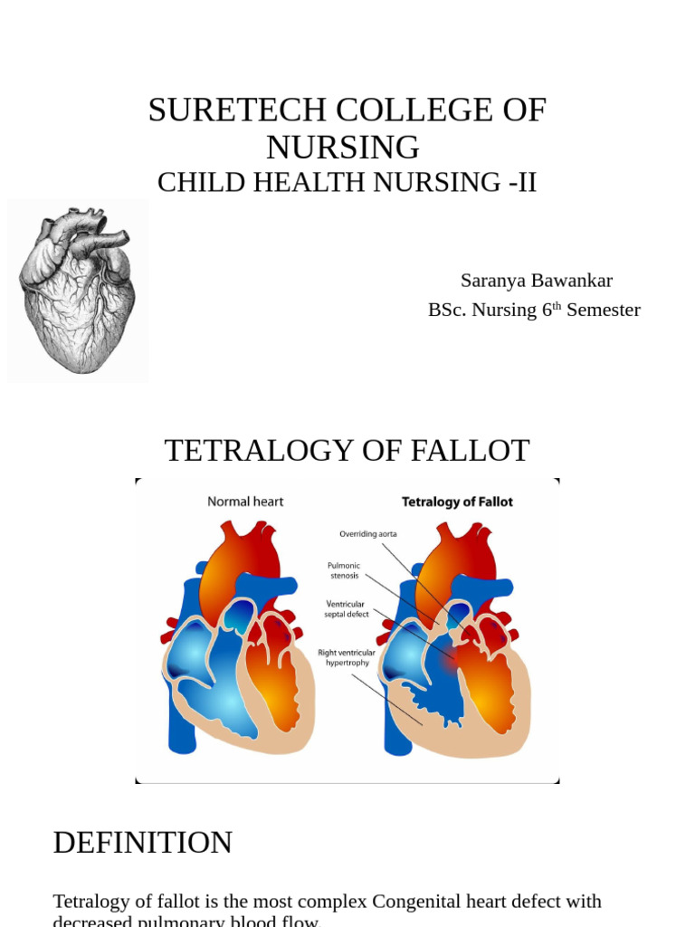 Tetralogy of fallot | PDF