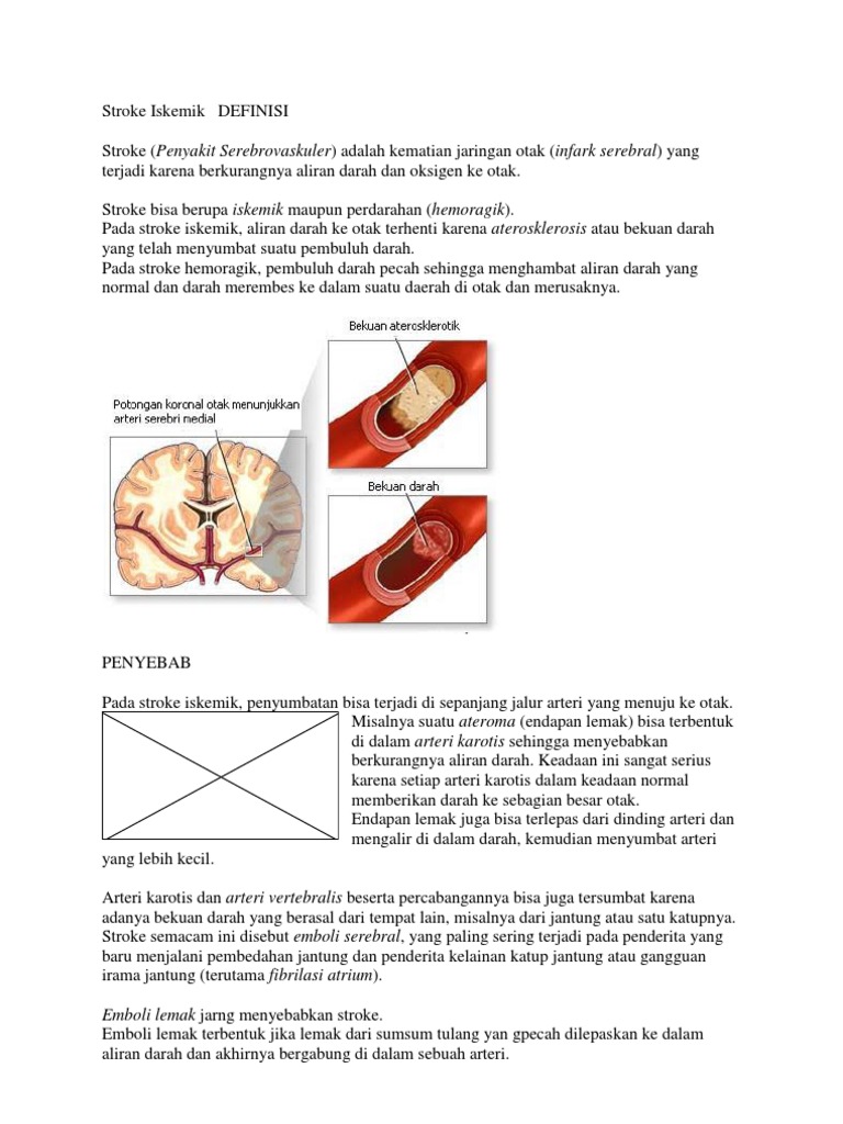 Stroke Iskemik | PDF