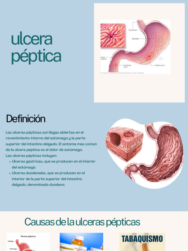 Ulcera Peptica | PDF | Especialidades Medicas | Medicina CLINICA