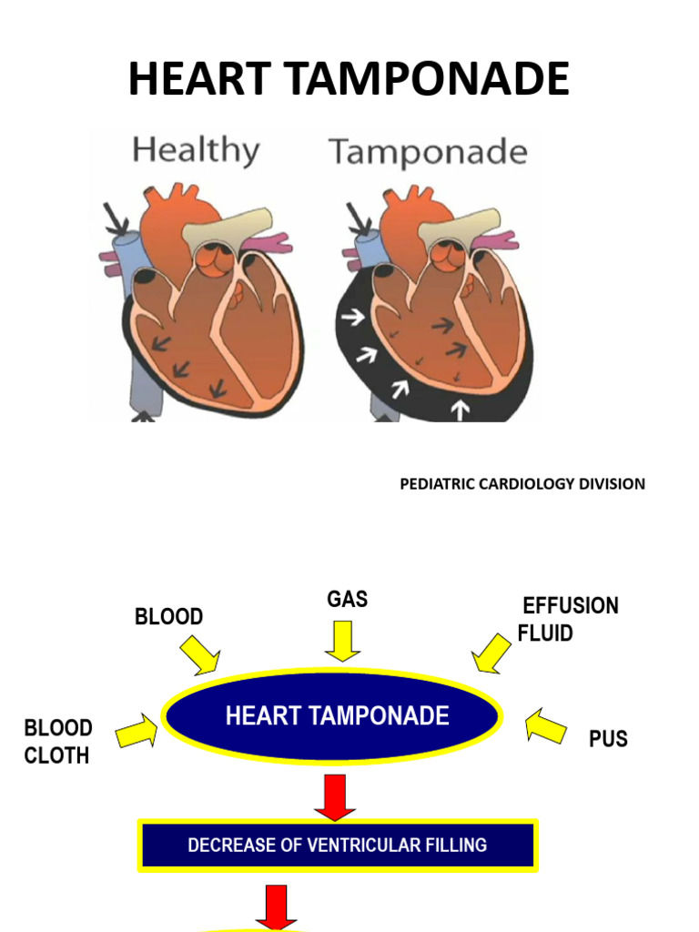 EMD2-K7-Heart Tamponade | PDF
