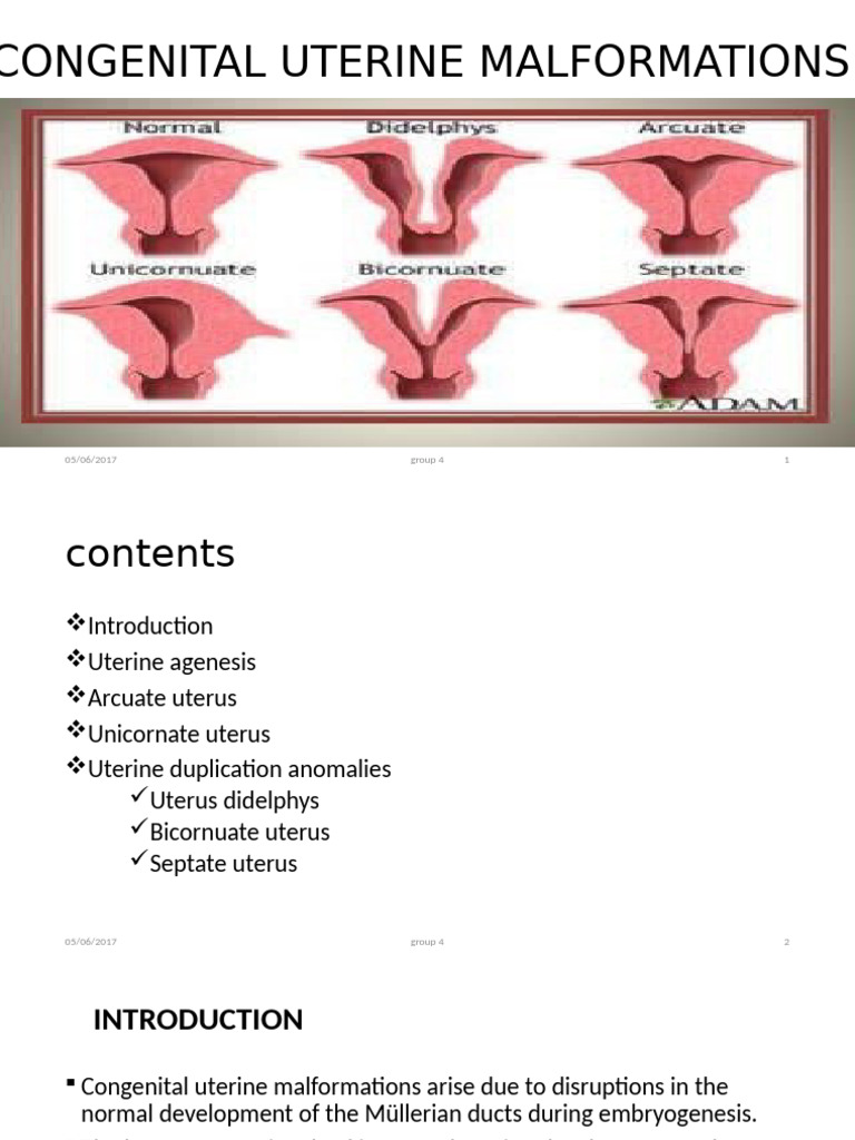 Congenital Uterine Malformations Overview | PDF | Uterus | Women's Health