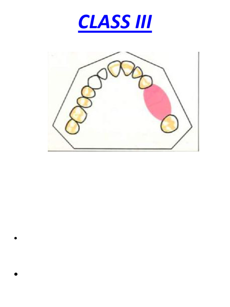 Class III -F-محول | PDF | Dentures | Dentistry