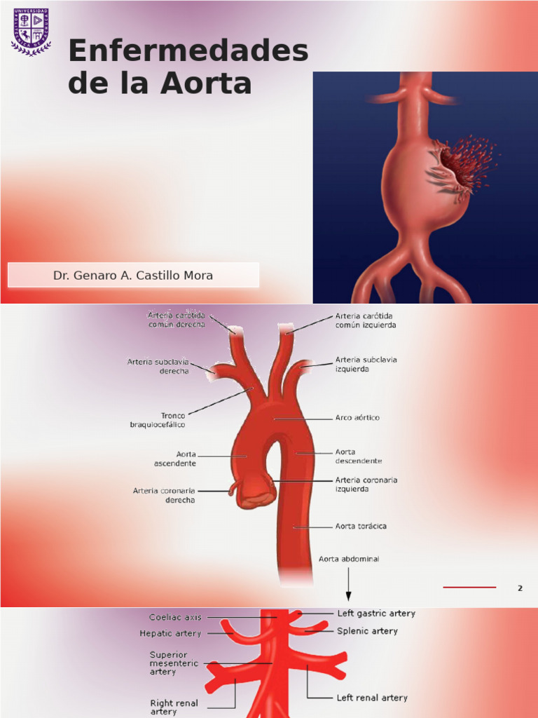 Enfermedades de La Aorta. | PDF | Enfermedades vasculares | Sistema cardiovascular
