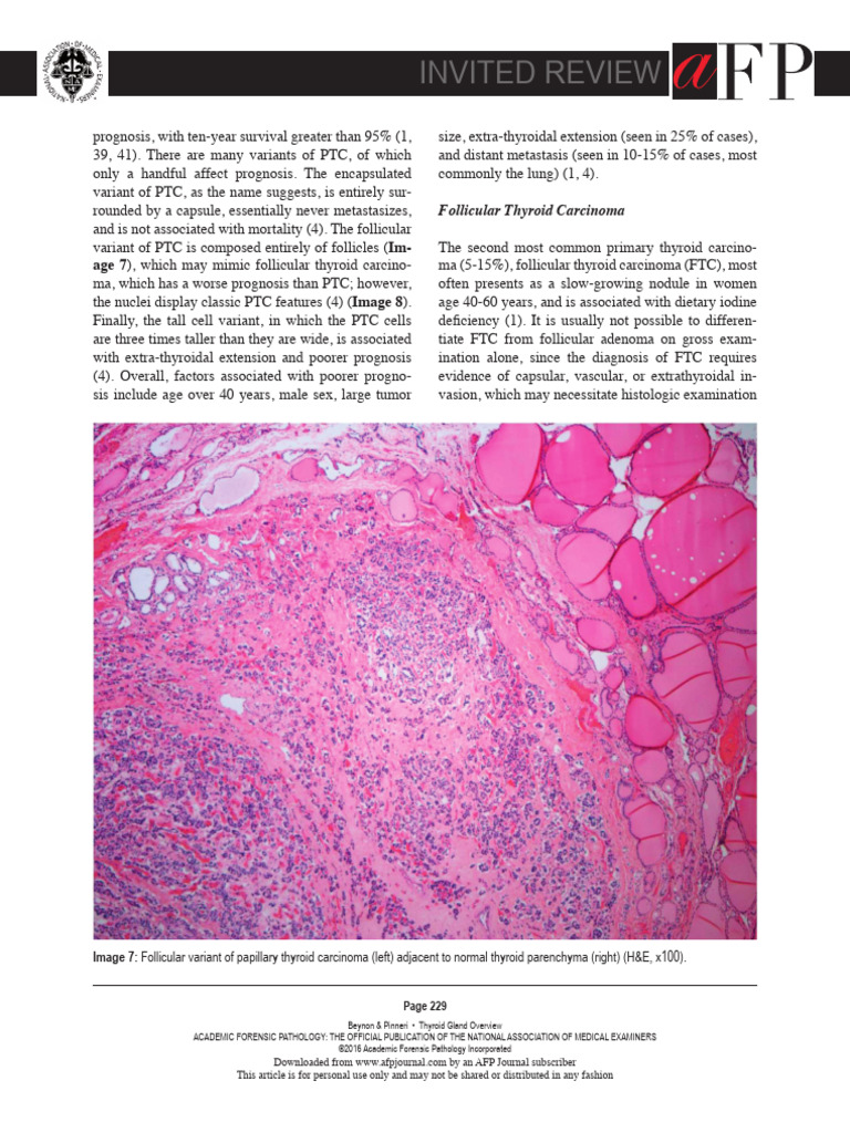 Thyroid Carcinoma Variants Overview | PDF | Thyroid | Metastasis