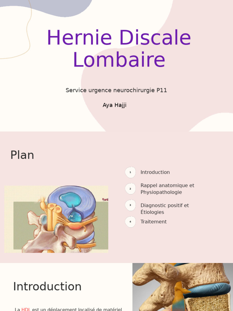 Hernie Discale Lombaire : Diagnostic et Traitement | PDF | Maladies et ...