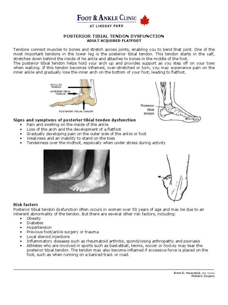 Posterior Tibial Tendon Dysfunction | PDF | Foot | Arthritis