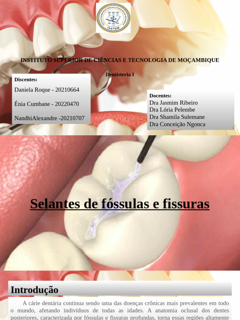 Selantes de Fóssulas e Fissuras Final | PDF | Dente humano | Odontologia